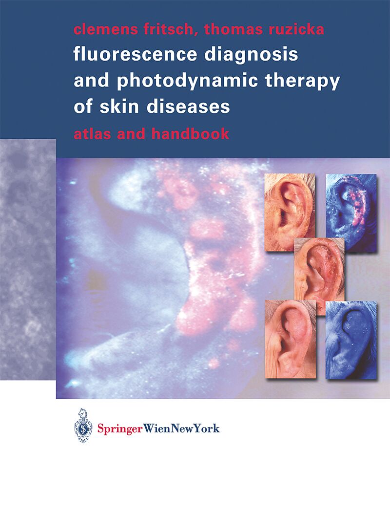 Fluorescence Diagnosis and Photodynamic Therapy of Skin Diseases by ...